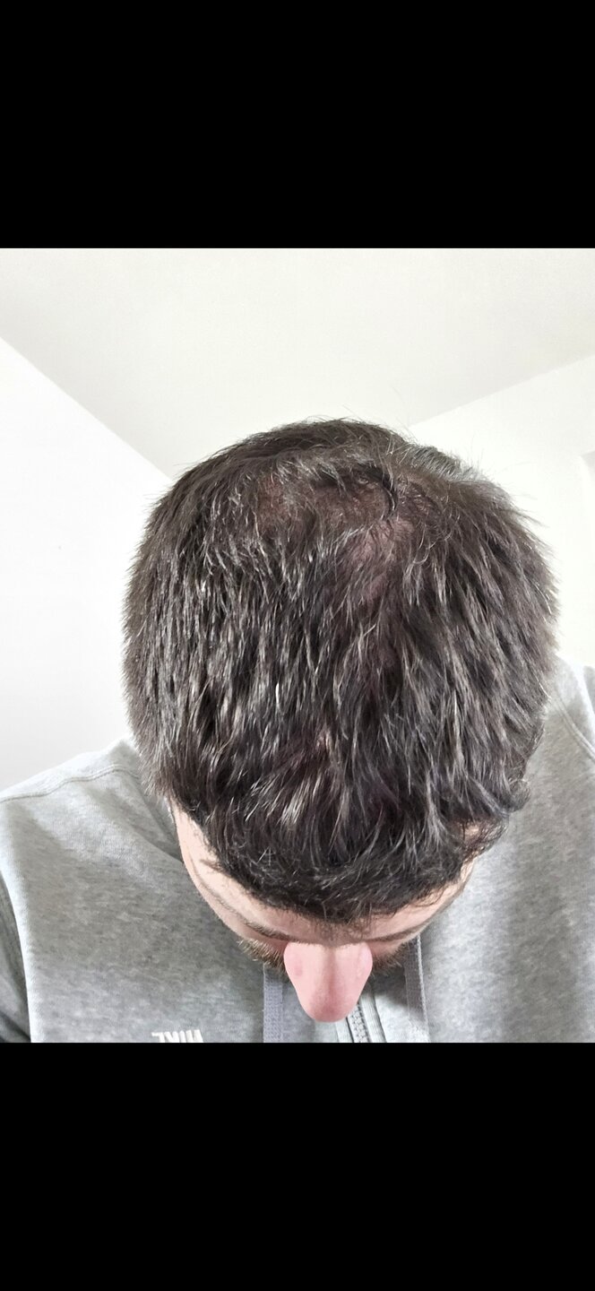 How many grafts for a Diffuse Thinner - Hair Restoration Questions and ...