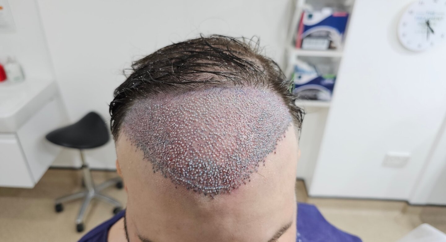 The Treatment Rooms, London | Dr Fernando | 2198 FUE Grafts | Frontal ...