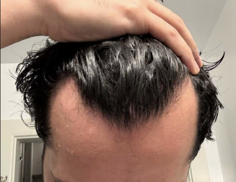 Upcoming Transplant and Wedding 4 months later - Hair Restoration ...