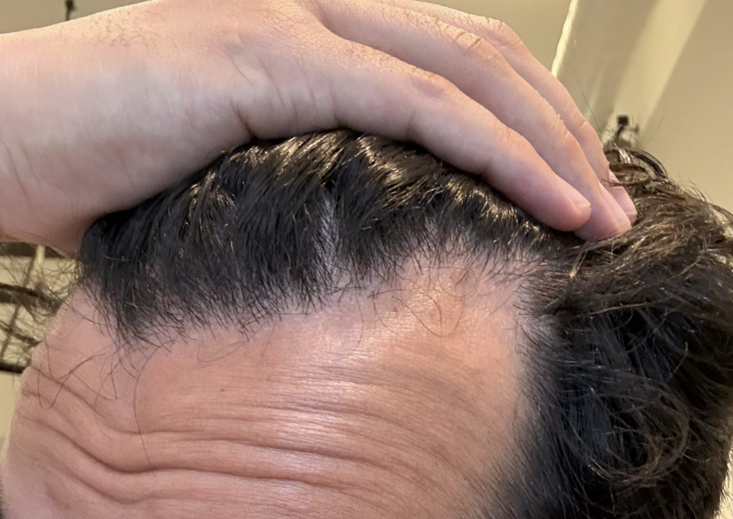 Upcoming Transplant and Wedding 4 months later - Hair Restoration ...