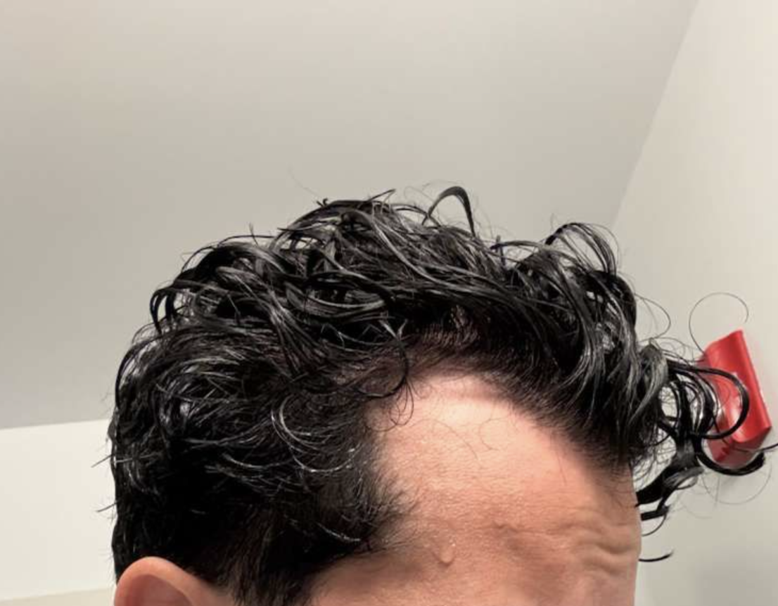 Upcoming Transplant and Wedding 4 months later - Hair Restoration ...