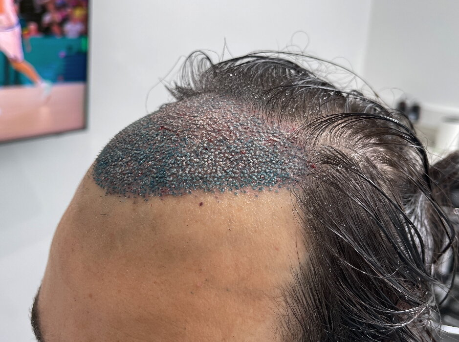 The Treatment Rooms, London | Dr Vara | 2148 FUE Grafts | Hairline ...