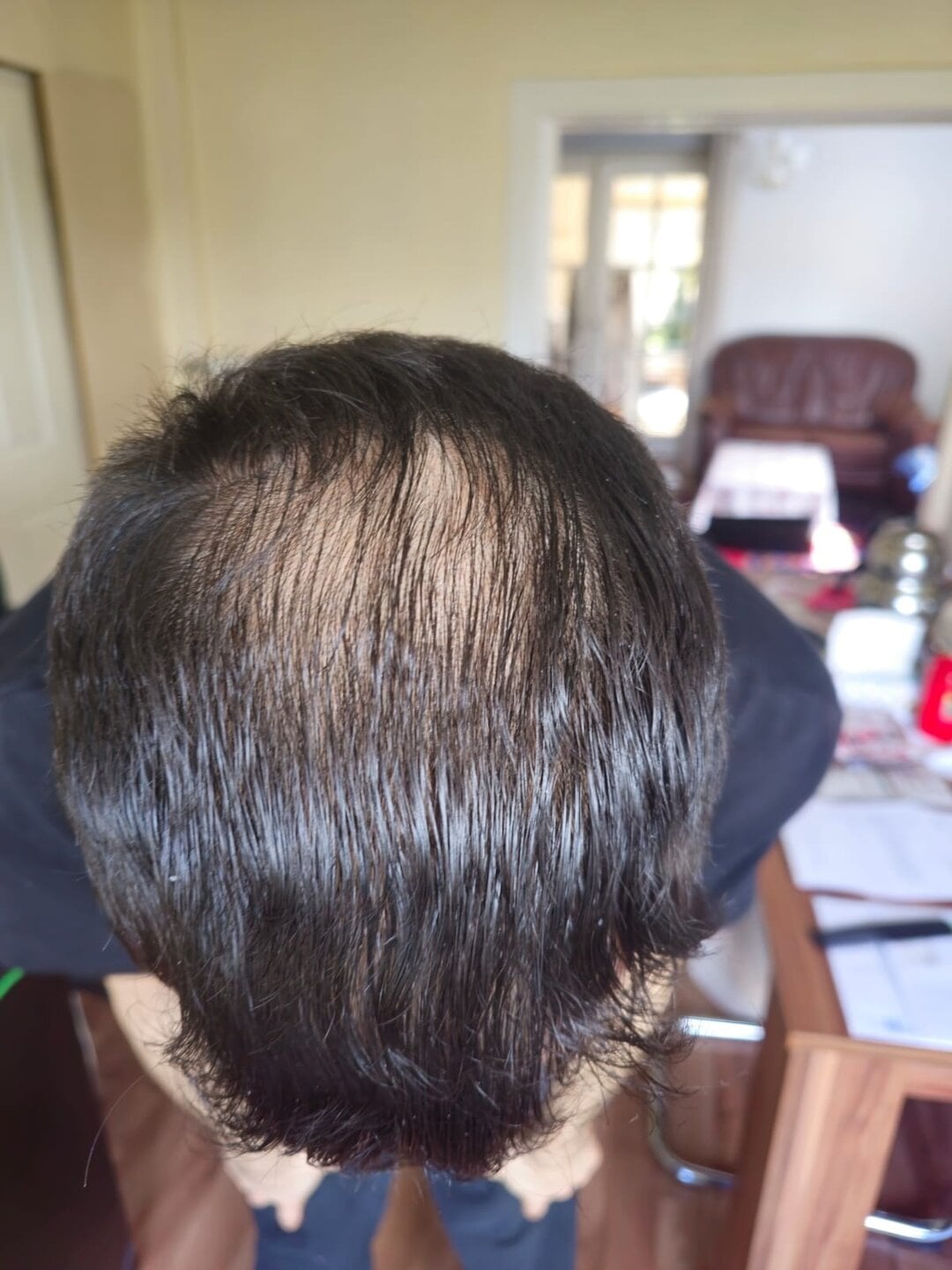 26yo Male, NW3 Vertex, Diffuse Thinning — First HT Planning, Need ...