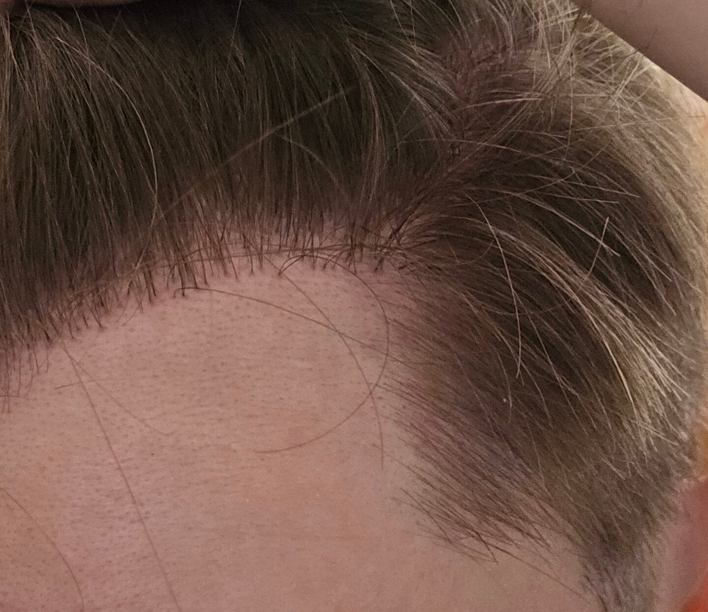 Seeking advice on revision of temporal hairline — wrong angle and ...