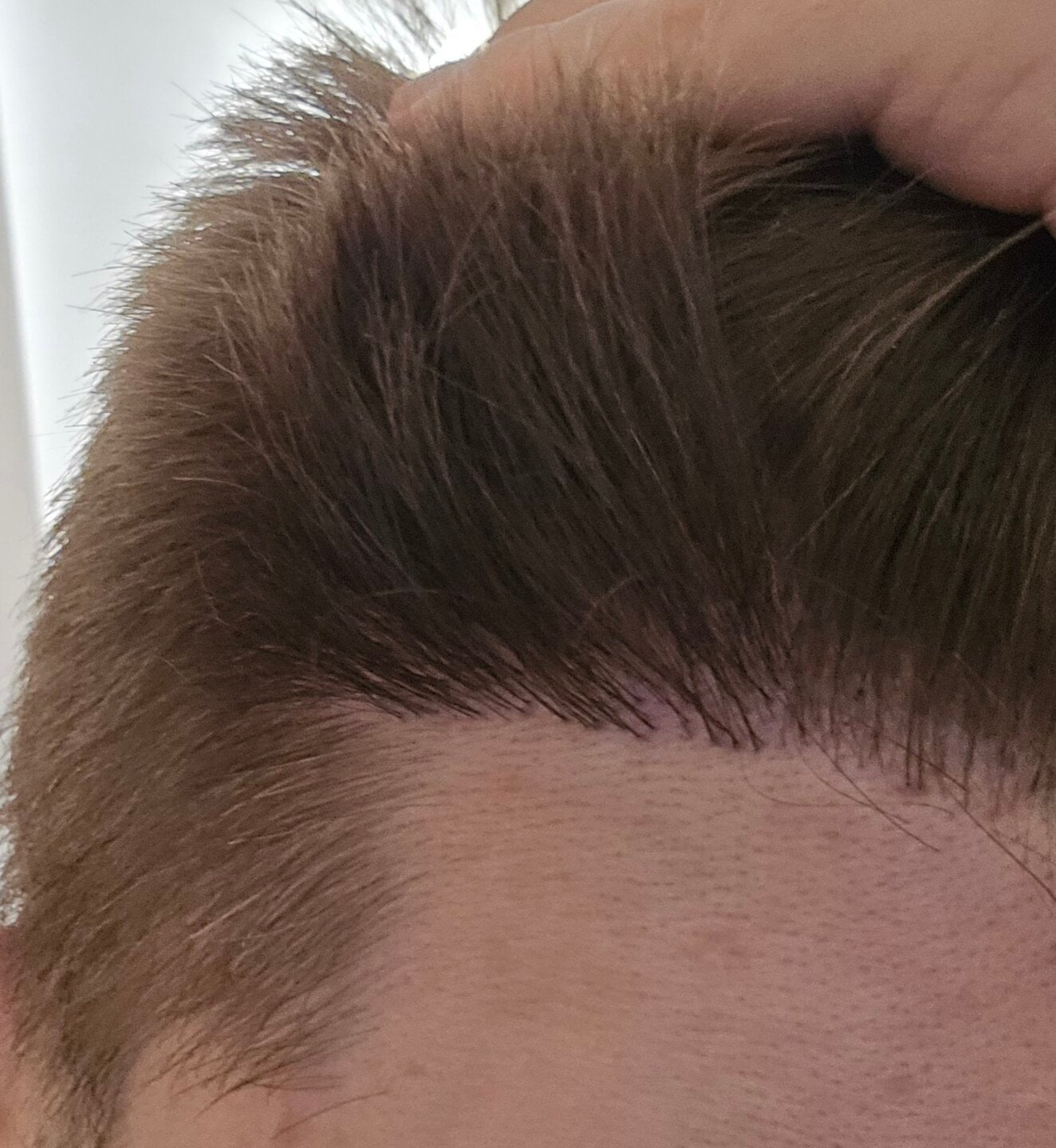 Seeking advice on revision of temporal hairline — wrong angle and ...
