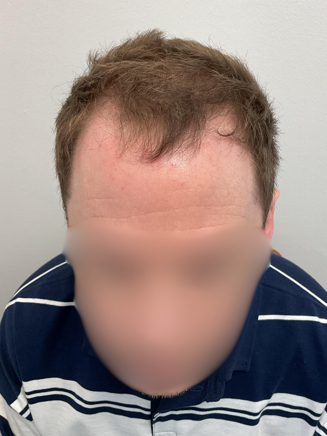 Dr. Raja Hair Restoration Leeds – FUE 1674 Grafts, 3676 Hairs - 12 ...