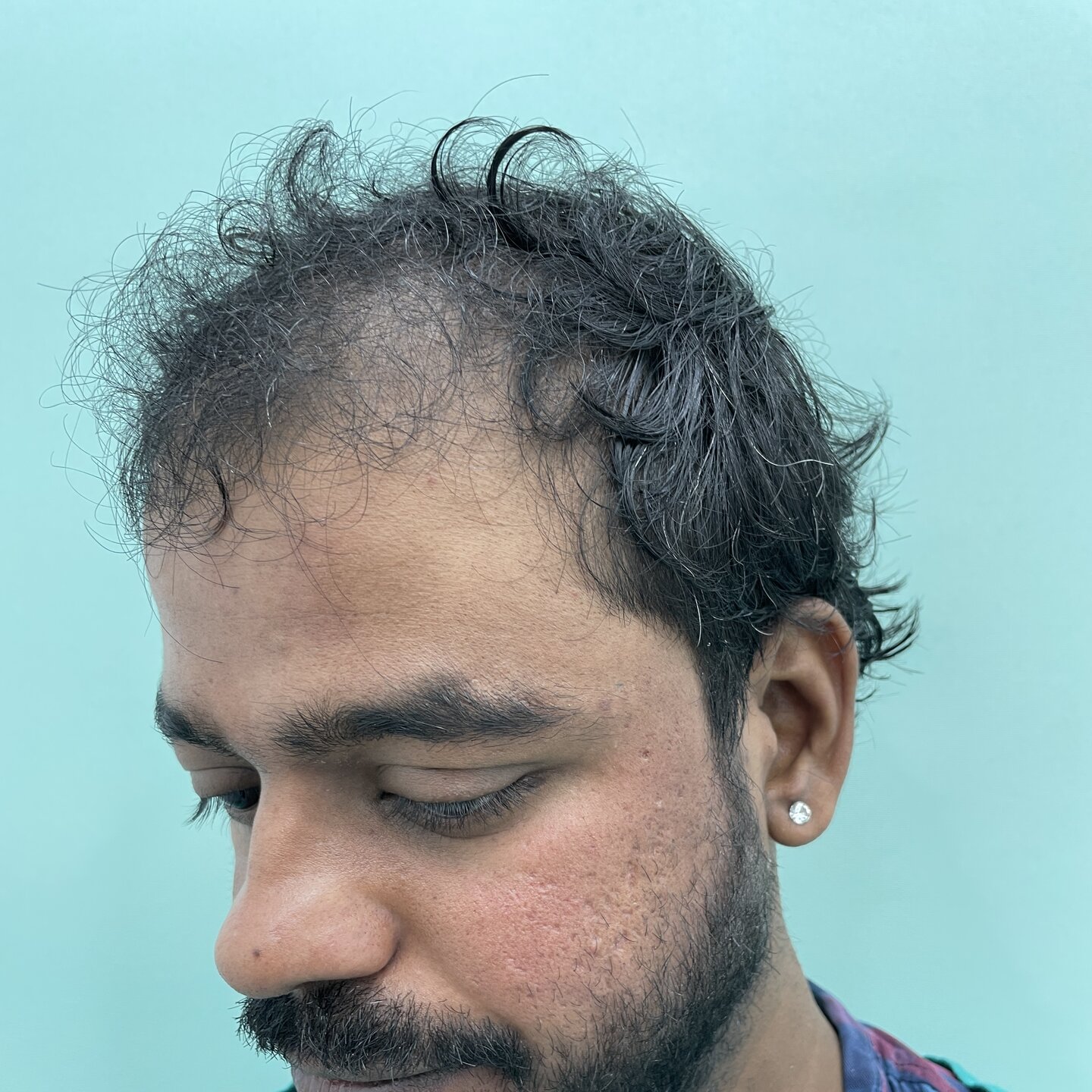 28 year old male, sudden hair thinning on top – looking for guidance ...