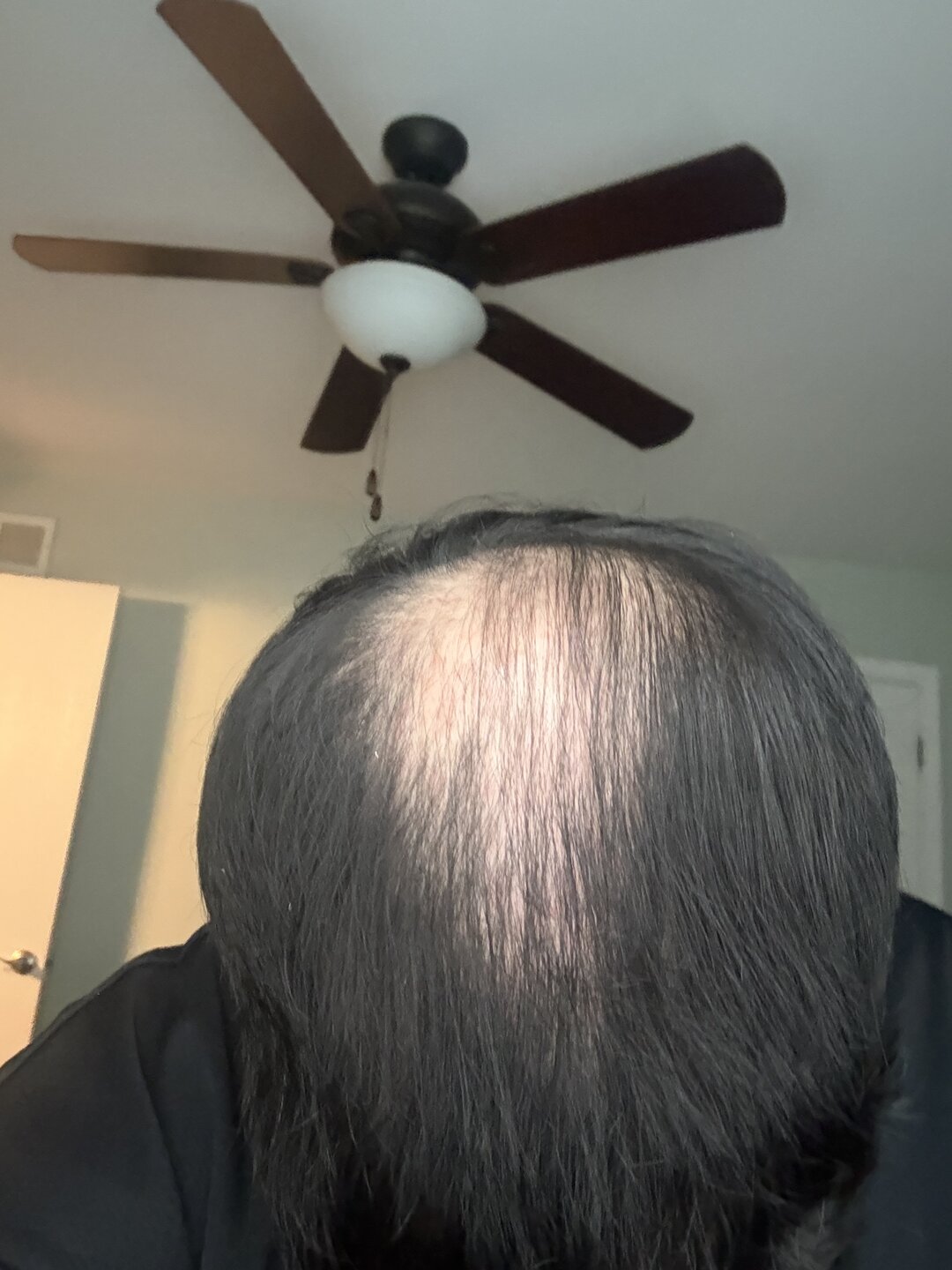 Was Told Donor Area Not Ideal. Advice Needed - Hair Restoration ...