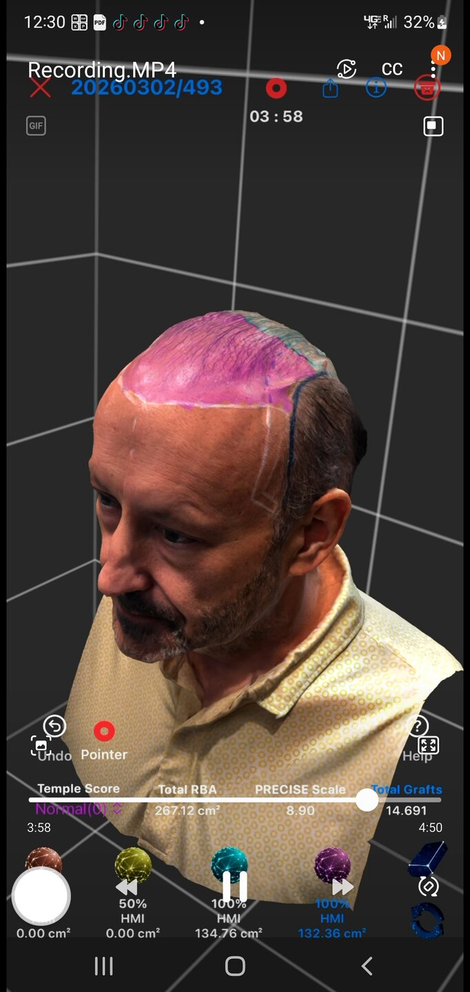 Dr. Pittella 14k Grafts - Very Grateful - Hair Transplant Reviews ...