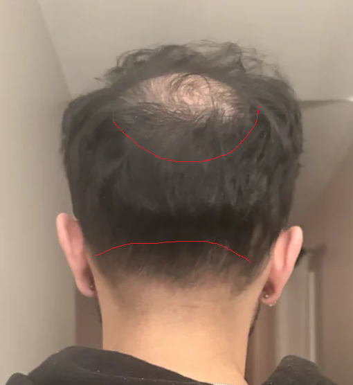 Was Told Donor Area Not Ideal. Advice Needed - Hair Restoration ...