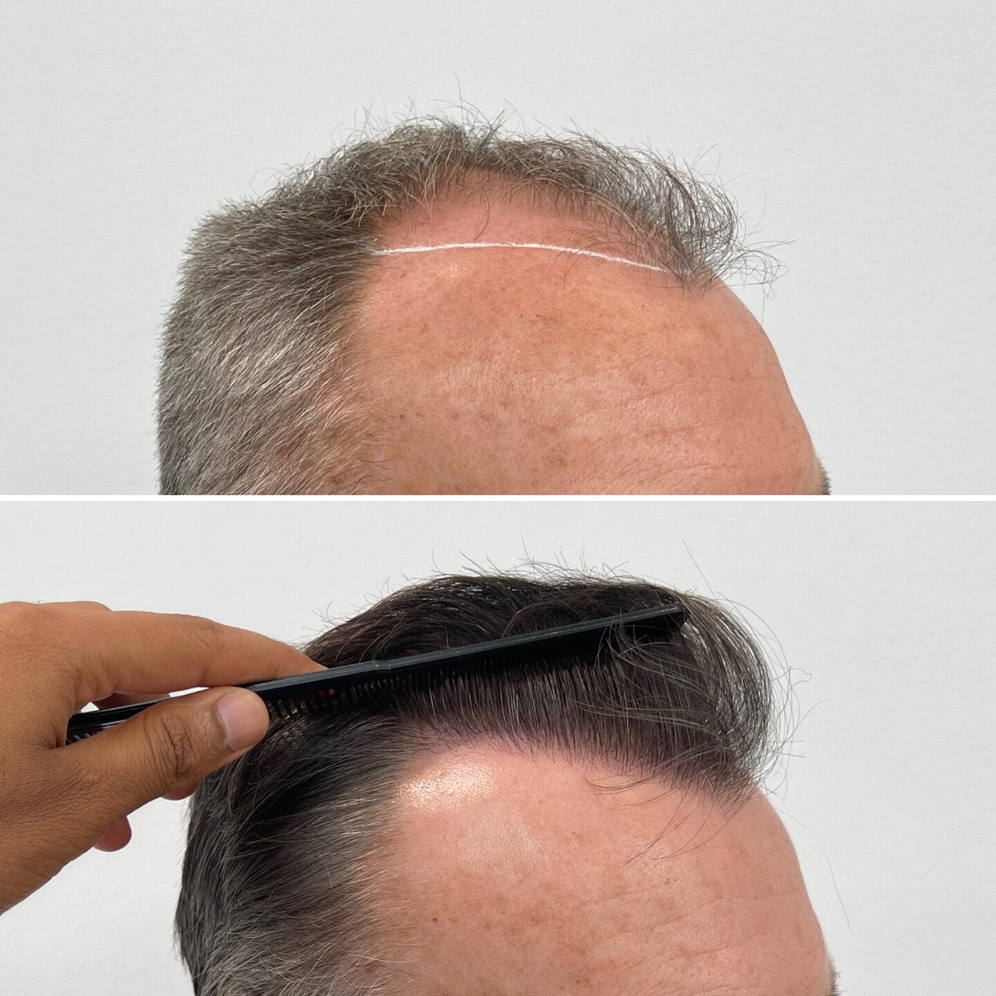 The Treatment Rooms, London | Dr Vara | 2078 FUE Grafts | Age ...