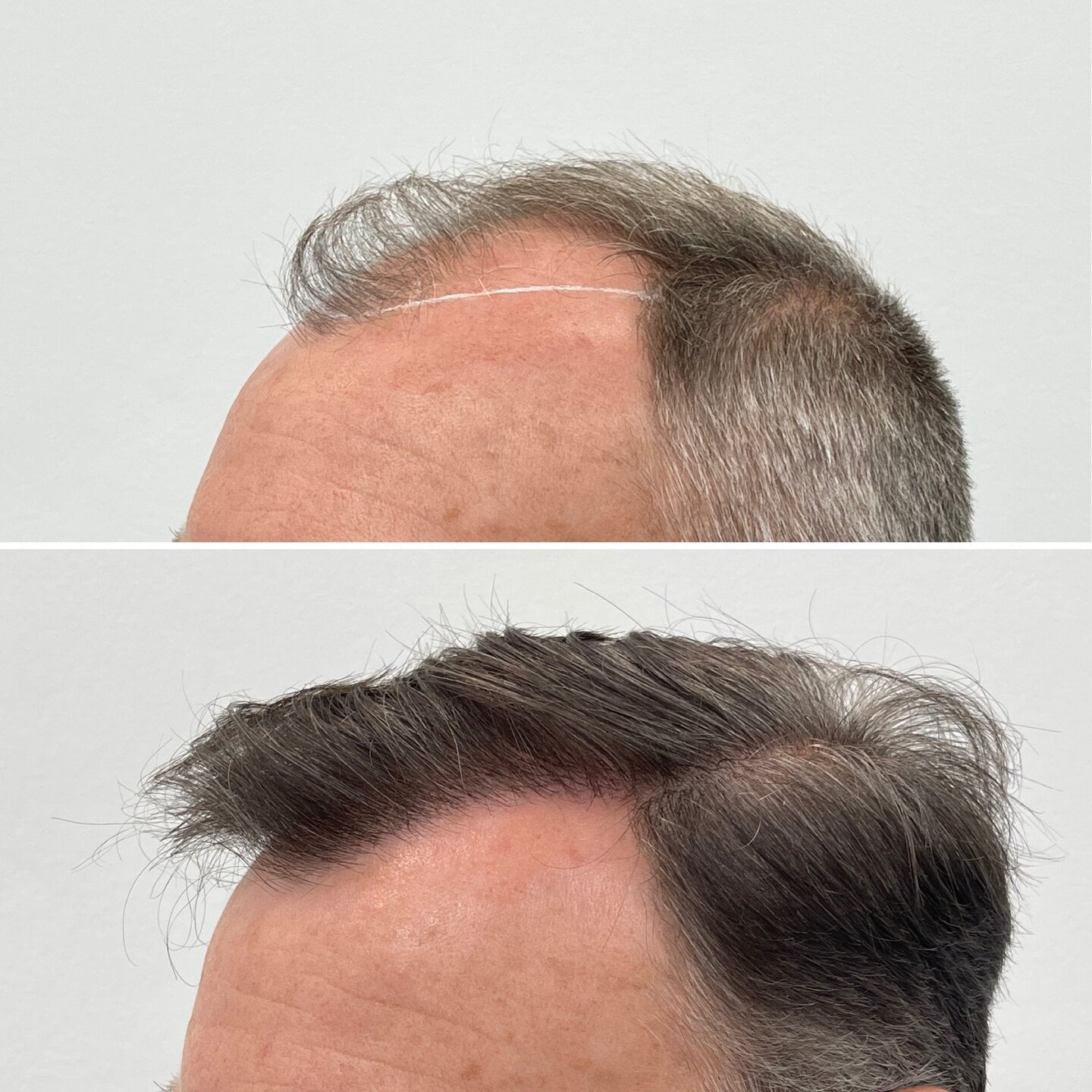 The Treatment Rooms, London | Dr Vara | 2078 FUE Grafts | Age ...