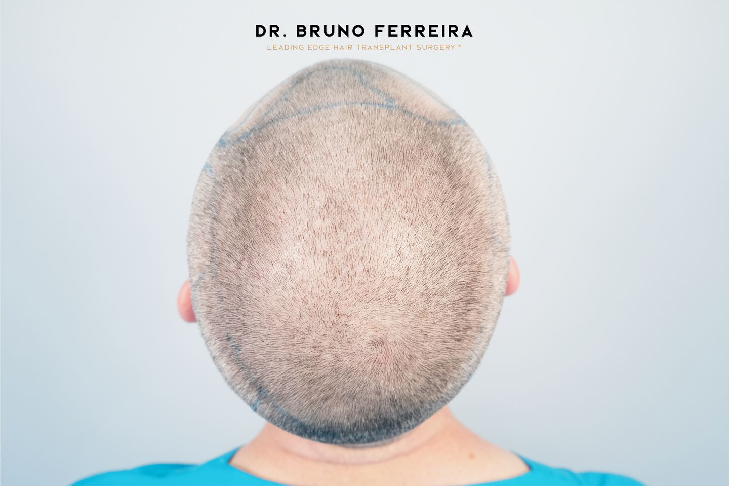 Dr Bruno Ferreira | 3031 Grafts | Apr 2026 | NW3 - Hair Transplant ...