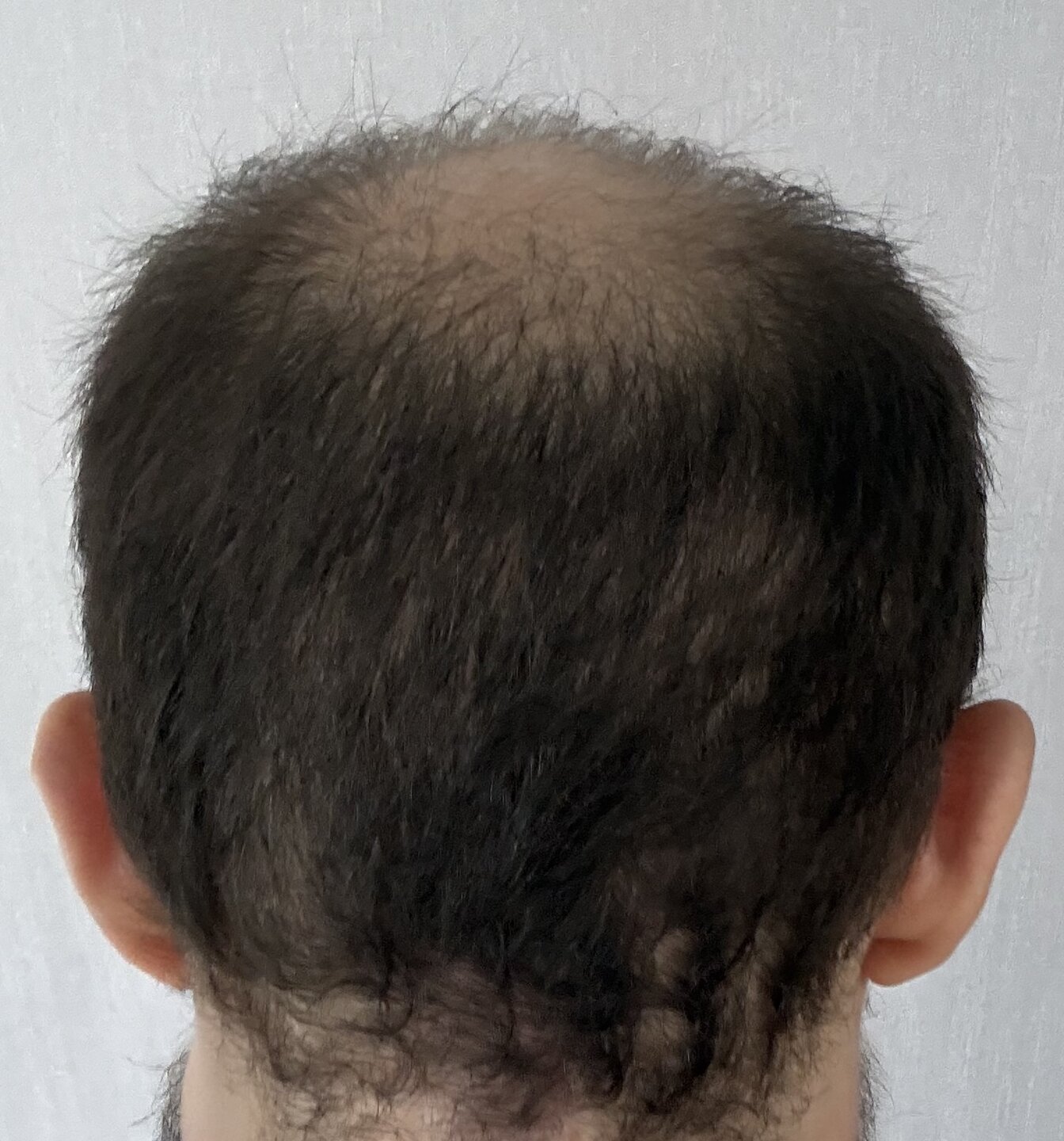 Booked next week with Dr. Ratchathorn — is my donor too weak to proceed ...