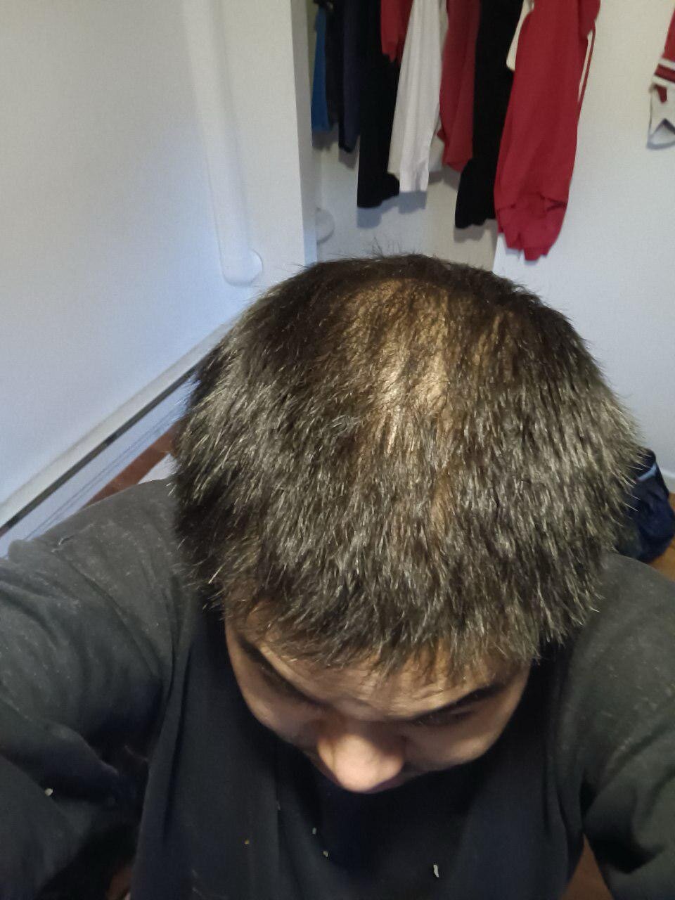 Hair thickening or no? - Hair Restoration Questions and Answers - Hair ...