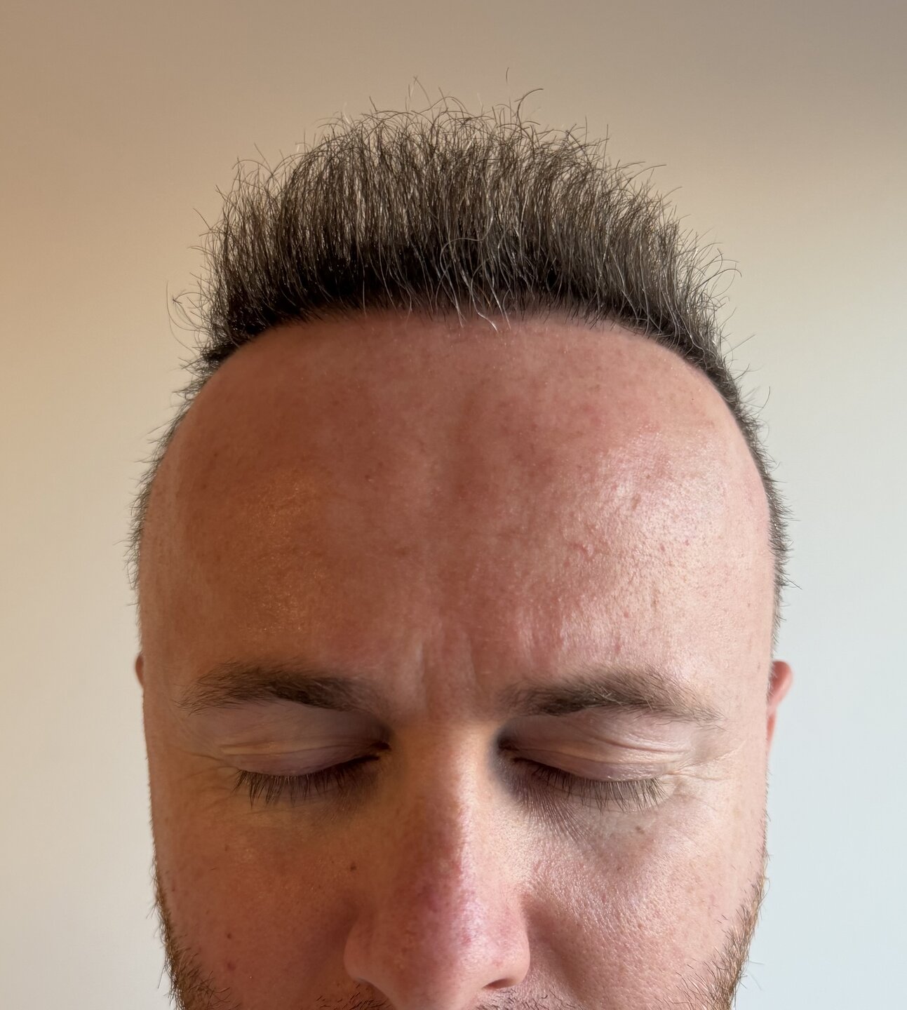 17400 Grafts ! Dr Abhinav Kumar - Nov 2025 - Page 2 - Hair Transplant ...