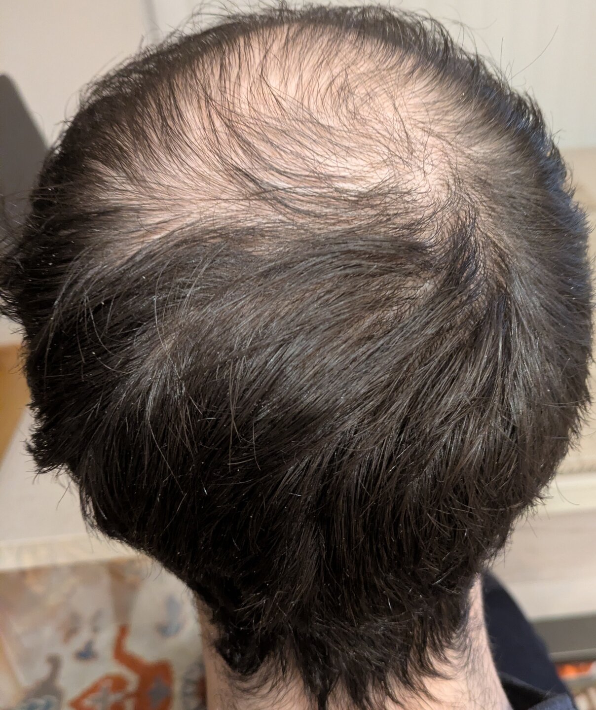 25 yo diffuse thinner with aggressive hair loss looking for lower end ...
