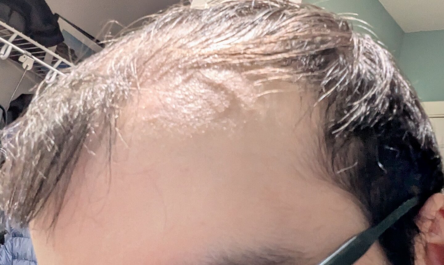 25 yo diffuse thinner with aggressive hair loss looking for lower end ...