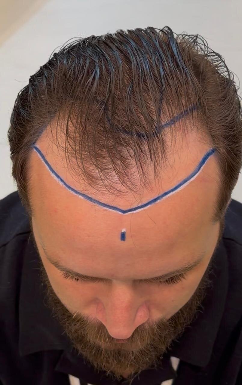 8,014K GRAFTS DR PITTELLA'S PATIENT! - Hair Transplant Reviews - Hair ...
