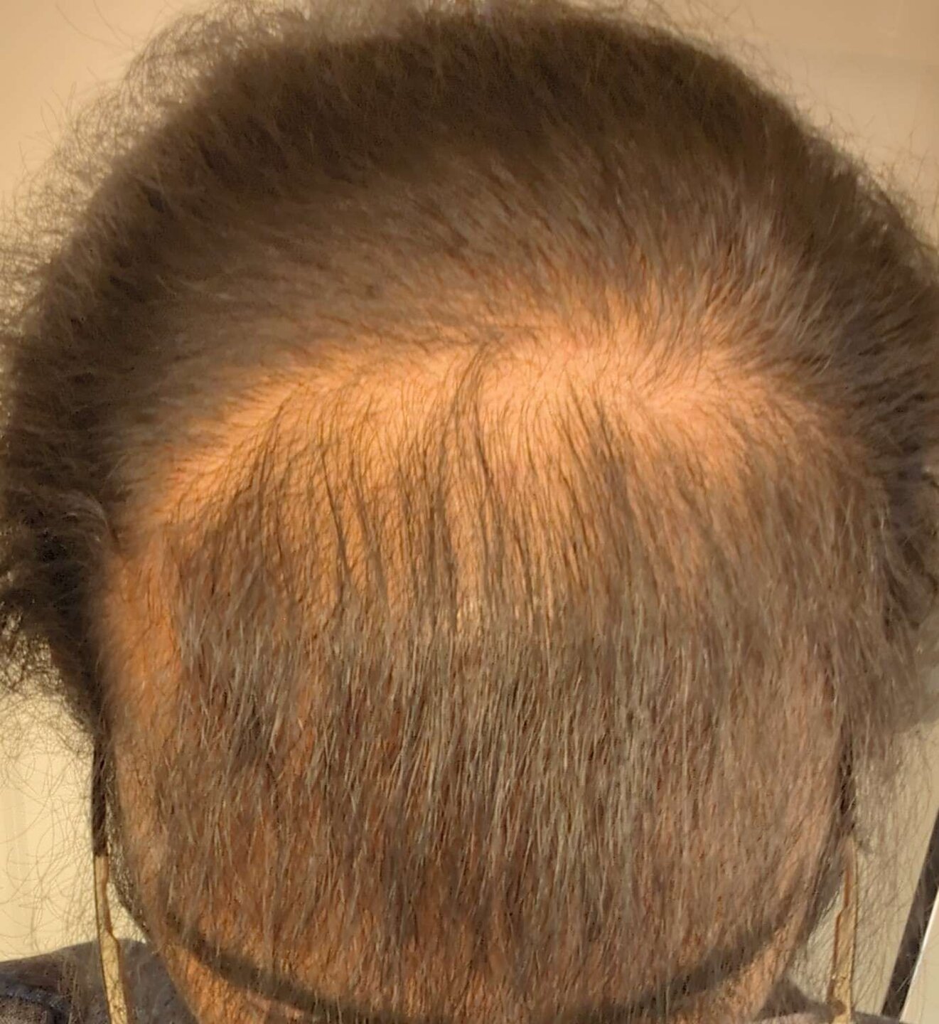 23M Graft count and surgeon recommendation - Hair Restoration Questions ...