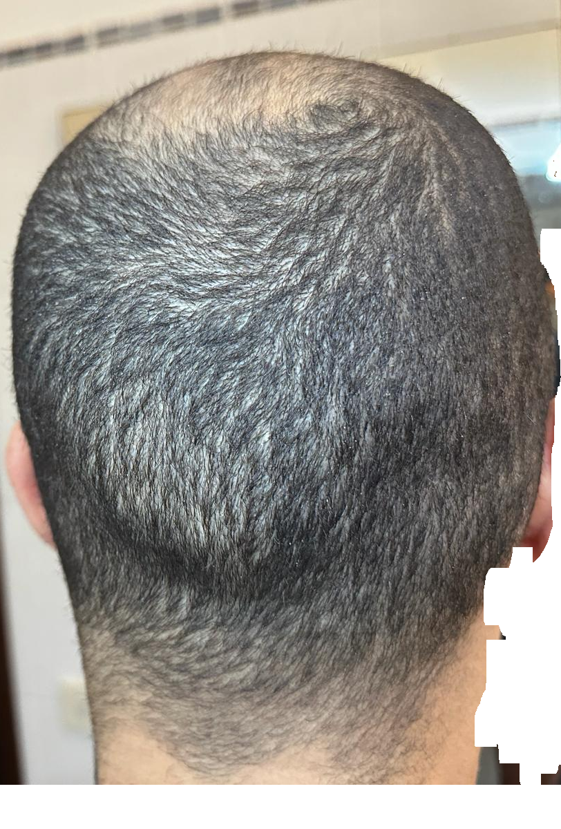 Advice on getting a hair transplant and finding a good doctor in Europe ...