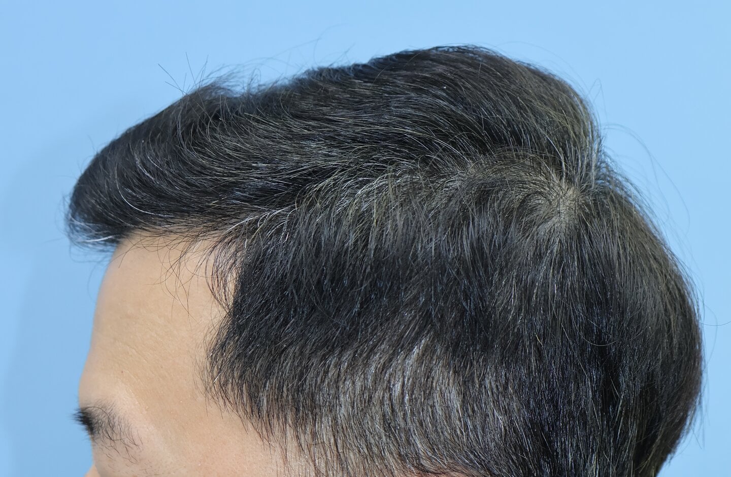Impressive 5-Month Transformation! + Oral Minoxidil Switch from topical ...