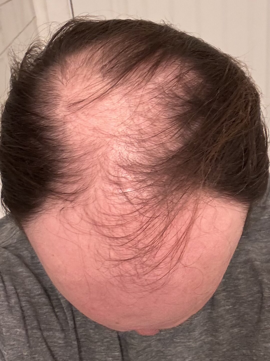 Thin/fine hair surgeon recommendations - Hair Restoration Questions and ...