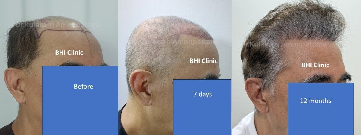 4,009 grafts FUE for grey hair patient, Dr.Kulakarn Amonpattana, BHI ...
