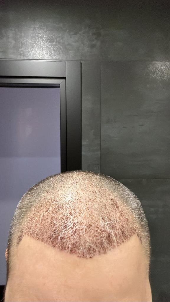 9-month hair transplant result Este in Turkey / Dr. Semih Alev — 3,500 ...