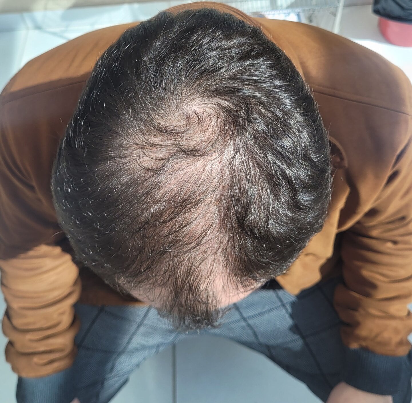24M Nwh 3/4/5 Self-esteem Destroyed Seeking Advice for HT - Hair ...