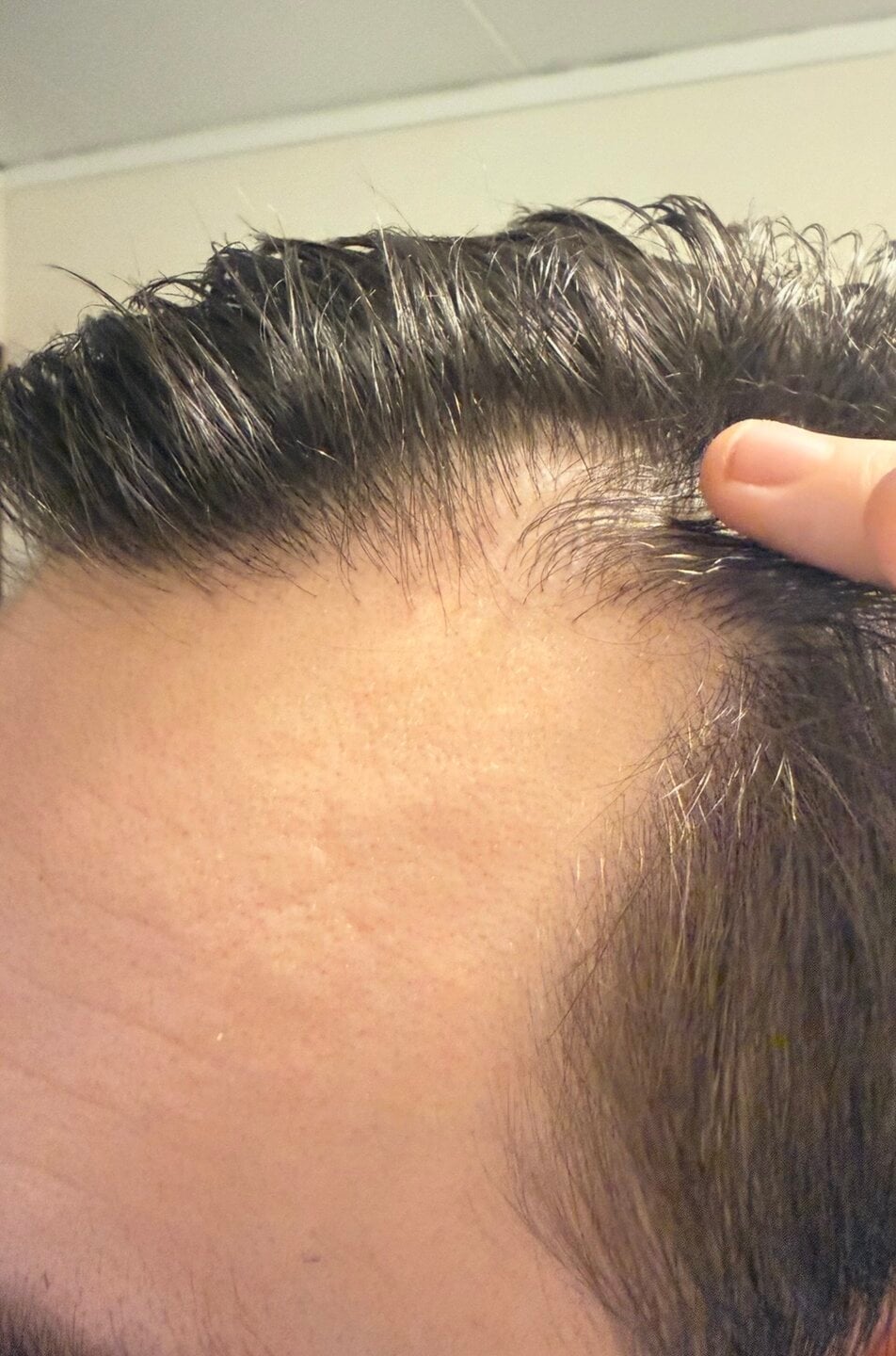 Detailed Patient Review | Dr. Emil George | Scandinavian Hair Institute ...