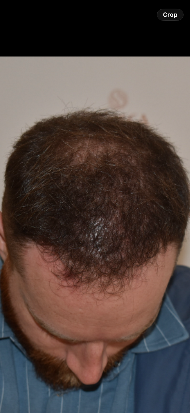 Dr Hala Elgmati - Seneca Medical Group | 1800 graft FUE | Results at 6 ...