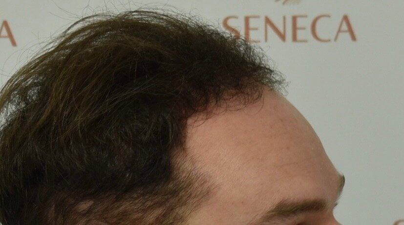 Dr Hala Elgmati - Seneca Medical Group | 1800 graft FUE | Results at 6 ...