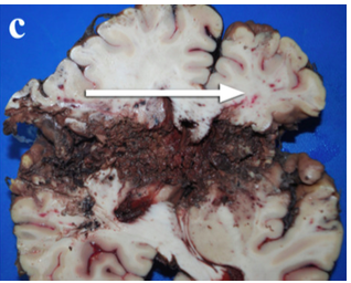 The Autopsy Doctors' Rear Head Entry Site vs. the Autopsy Photos of the ...