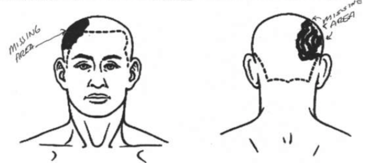 JFK: What The Doctors Saw validates there was no exit hole in the back ...