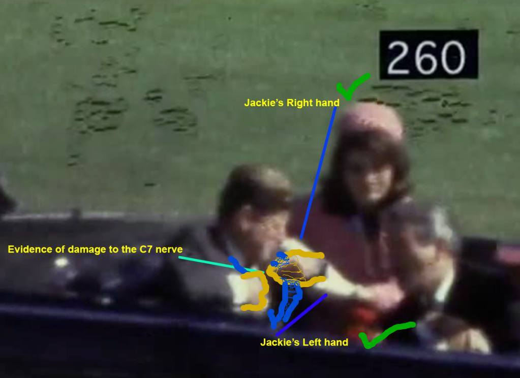 Dismantling the Single Bullet Theory Pt 5 - Page 17 - JFK Assassination ...