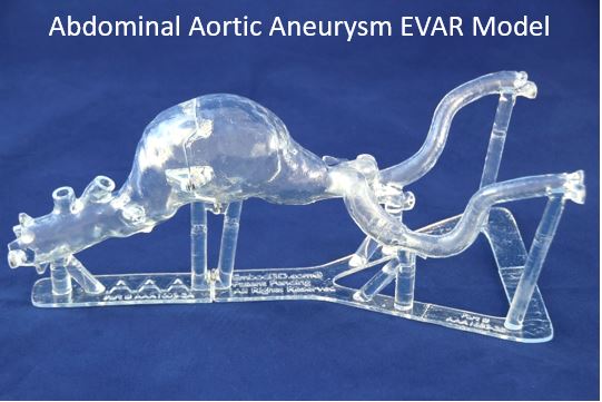 01 Abdominal Aortic Aneurysm EVAR Model - Members Albums Category ...