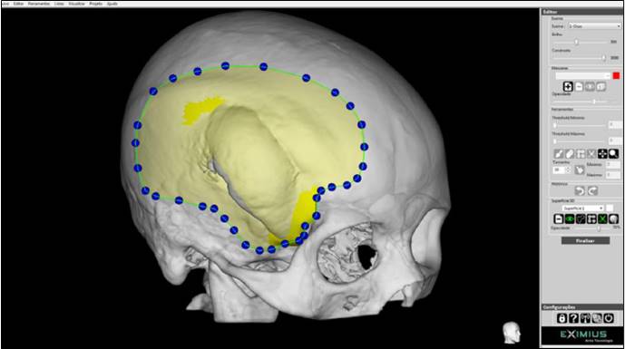Medical 3D Printing for Skull Surgery - Deirdre_Manion-Fischer's Blog ...