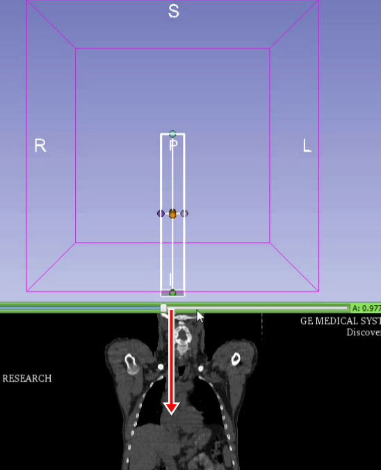 How to Convert Multiple 3D Printable Bone Model STL Files from a CT ...