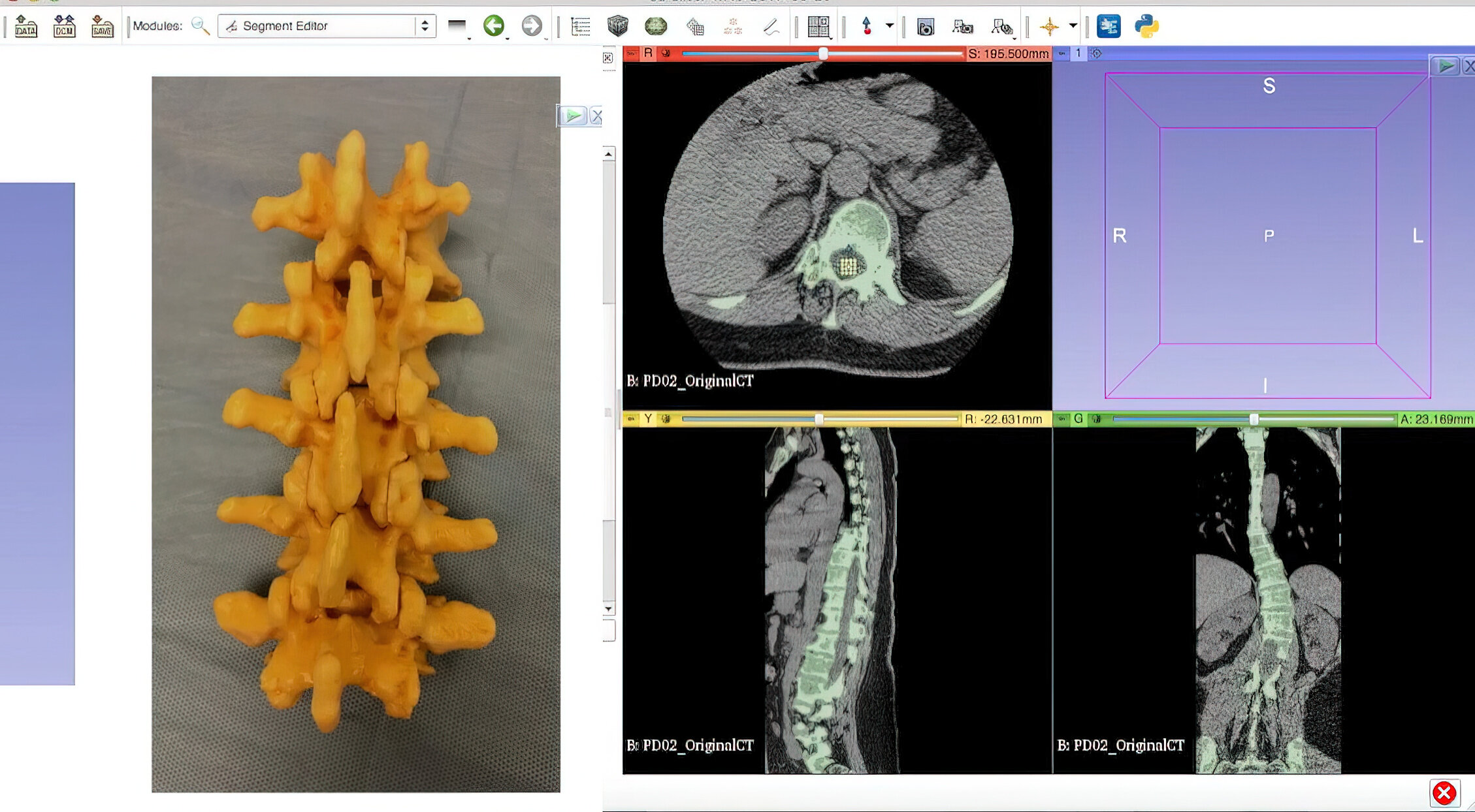 printable 3d brain from MRI scan, - MRIs - embodi3D.com