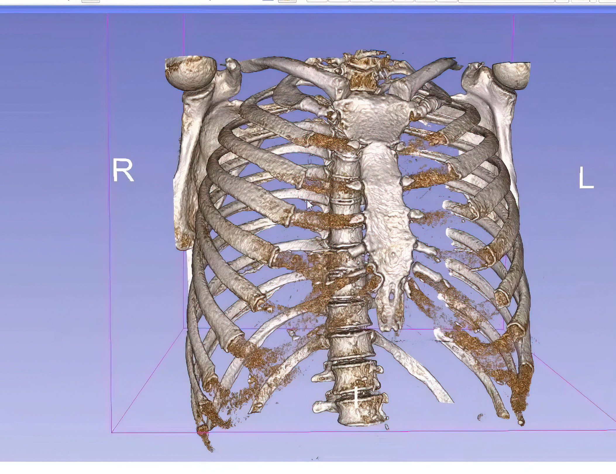 printable 3d brain from MRI scan, - MRIs - embodi3D.com
