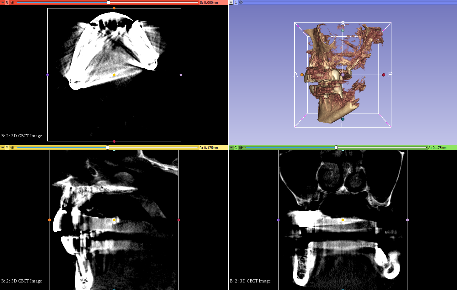2 3D CBCT Image - democratiz3D® Processing - embodi3D.com