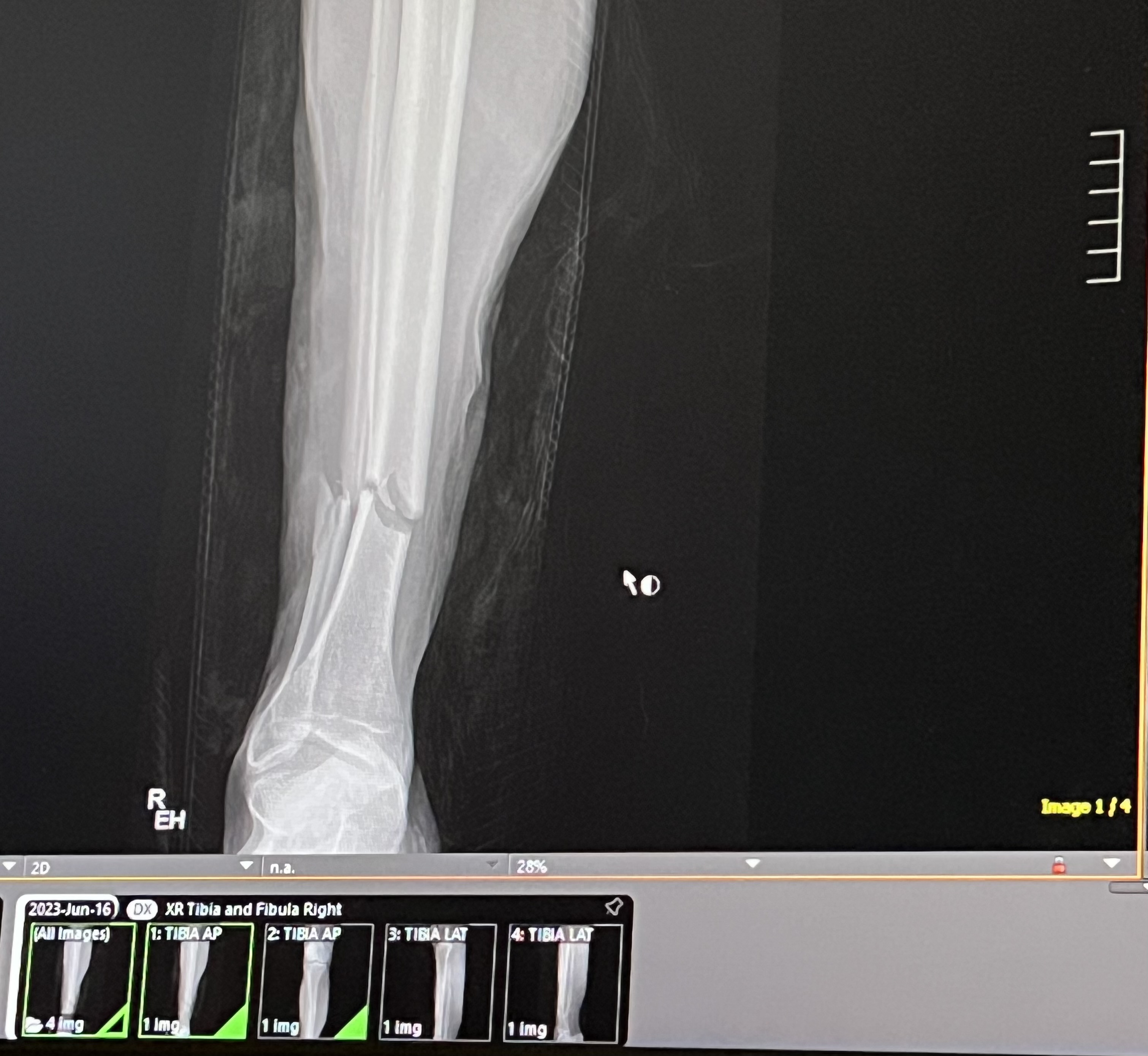 Full open fracture of leg at 4mph -- trying to discover cause. Could ...