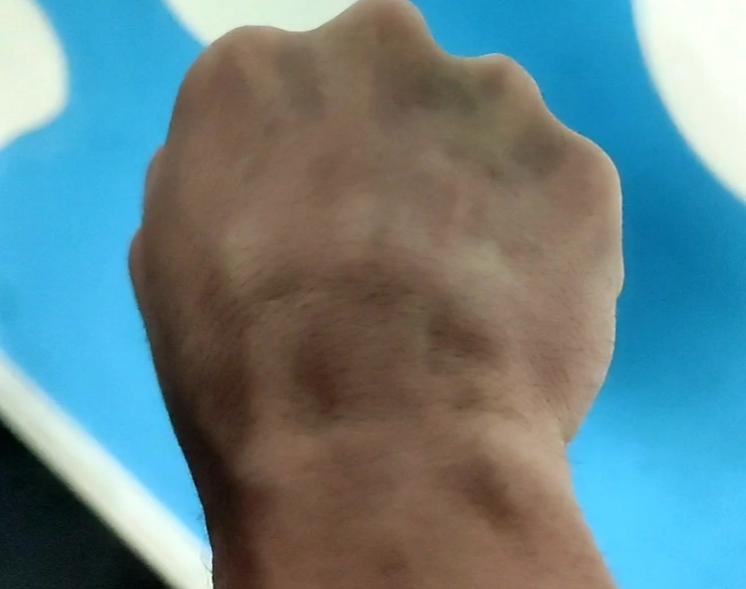 My Hand Hypertrophy experiment results - GripBoard - The GripBoard